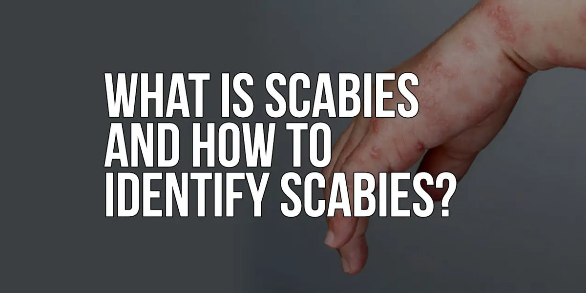 What is Scabies and How to Identify Scabies?