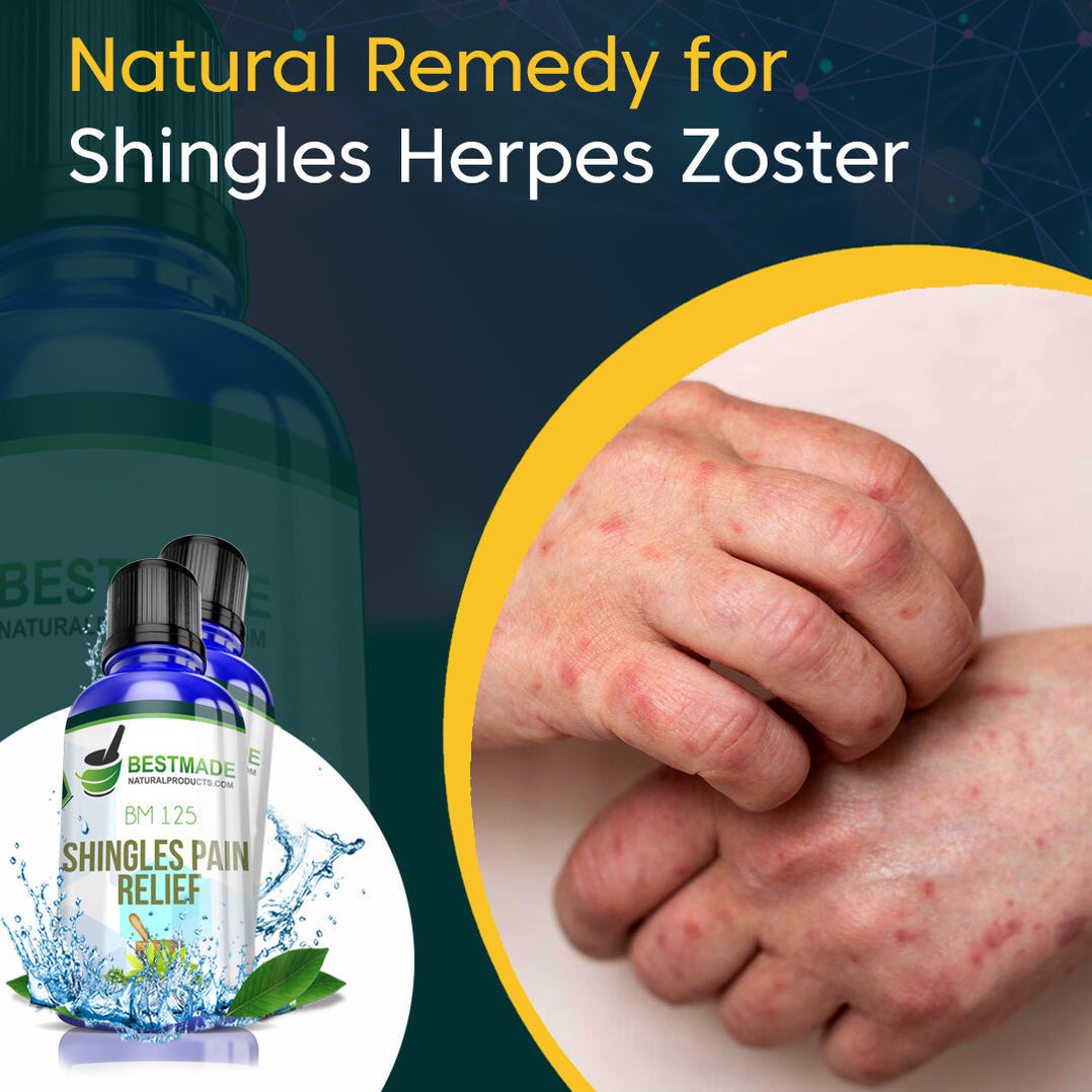 Shingles & Rash Natural Pain Relief (BM125)